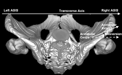 Analysis of acetabular version in the native hip: comparison between 2D ...