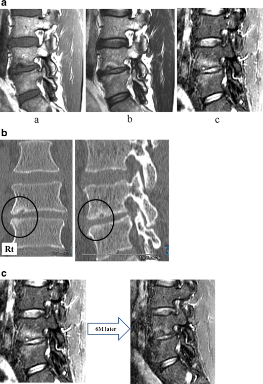 Modic type I changes of the lumbar spine in golfers | SpringerLink