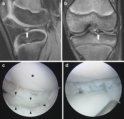 Wrisberg variant of the discoid lateral meniscus with flipped meniscal ...