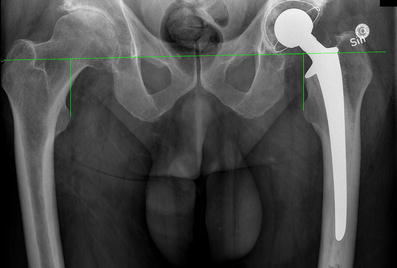 Measurement of leg length discrepancy after total hip arthroplasty. The ...