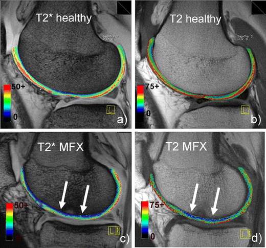 T2 star relaxation times for assessment of articular cartilage at 3 T ...