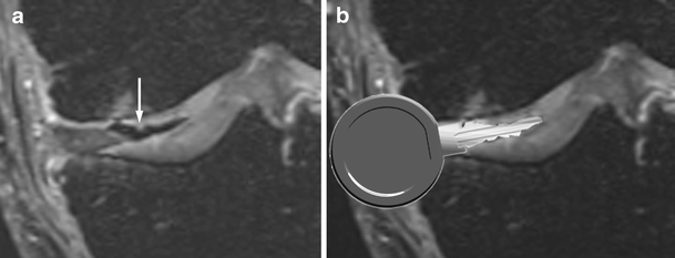 Vacuum phenomenon: prevalence and appearance in the knee with 3 T ...