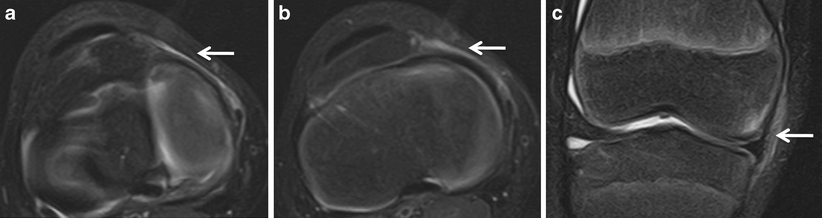 High resolution magnetic resonance imaging of the patellar retinaculum ...