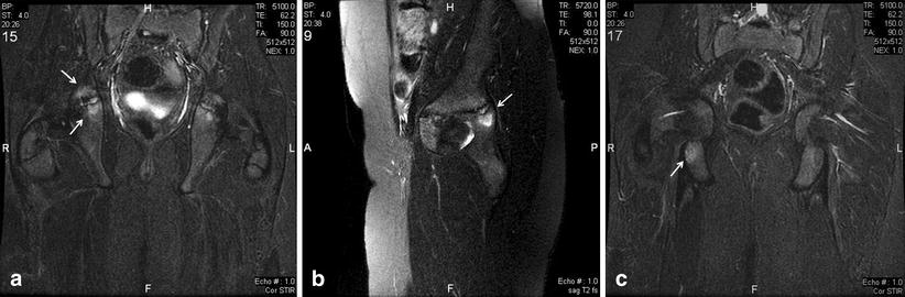 Bilateral triradiate cartilage injury: an overuse syndrome in an ...