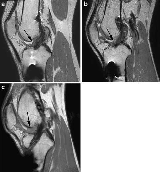 Analysis of cyclops lesions after different anterior cruciate ligament ...