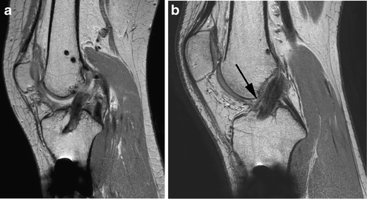 Analysis of cyclops lesions after different anterior cruciate ligament ...