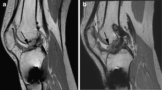 Analysis of cyclops lesions after different anterior cruciate ligament ...