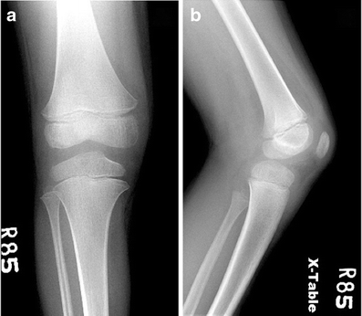Magnetic resonance imaging appearance of scurvy with gelatinous bone ...