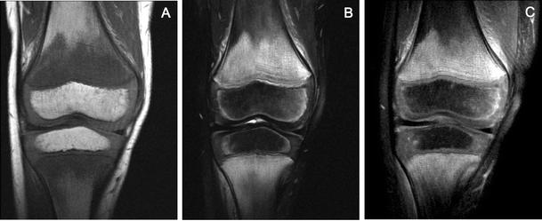 Magnetic resonance imaging appearance of scurvy with gelatinous bone ...