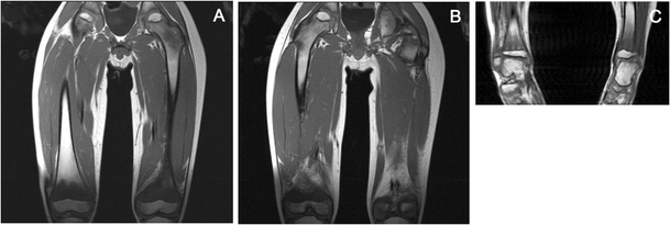 Magnetic resonance imaging appearance of scurvy with gelatinous bone ...