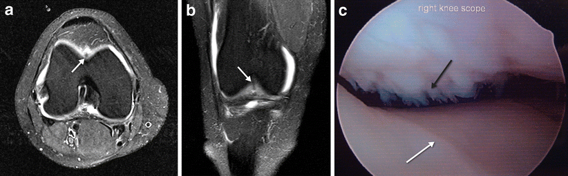 The trochlear cleft: the “black line” of the trochlear trough ...