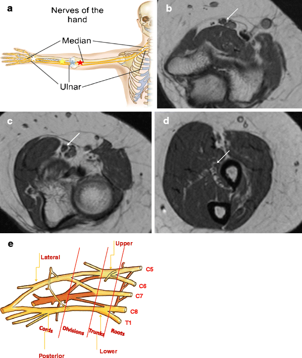 Magnetic resonance neurography of median neuropathies proximal to the ...