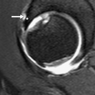 Paralabral cysts in the hip joint: findings at MR arthrography ...
