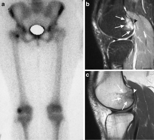 Subchondral impaction fractures of the non-weight-bearing portion of ...