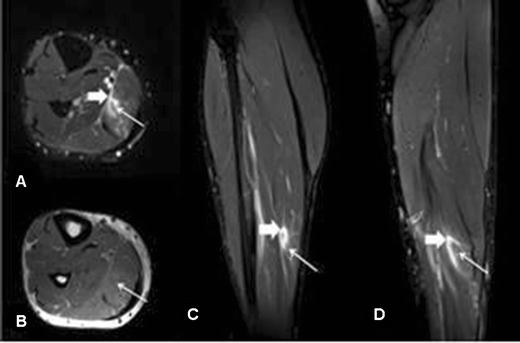 The soleus muscle: MRI, anatomic and histologic findings in cadavers ...