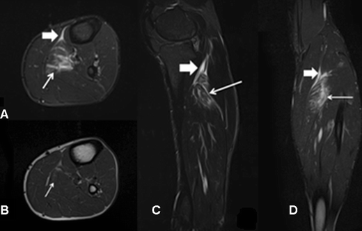 The soleus muscle: MRI, anatomic and histologic findings in cadavers ...
