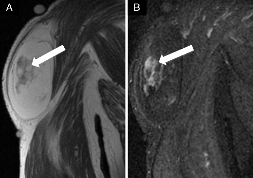 MRI characteristics of lipoma and atypical lipomatous tumor/well ...