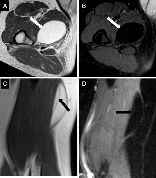 MRI characteristics of lipoma and atypical lipomatous tumor/well ...