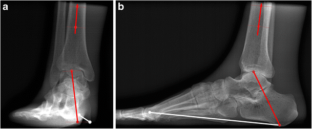 Three-dimensional hindfoot alignment measurements based on biplanar ...