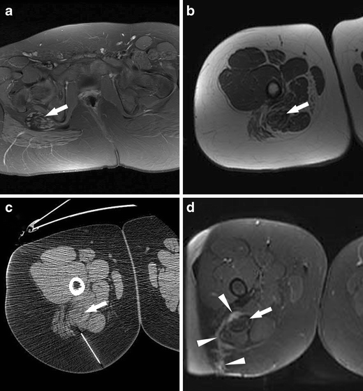 Neuromuscular choristoma: characteristic magnetic resonance imaging ...