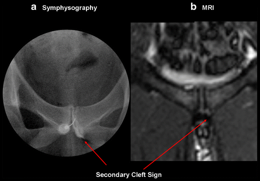 “Superior cleft sign” as a marker of rectus abdominus/adductor longus ...