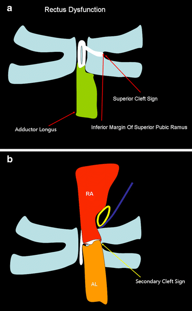 “Superior cleft sign” as a marker of rectus abdominus/adductor longus ...