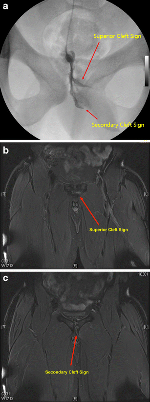 “Superior cleft sign” as a marker of rectus abdominus/adductor longus ...