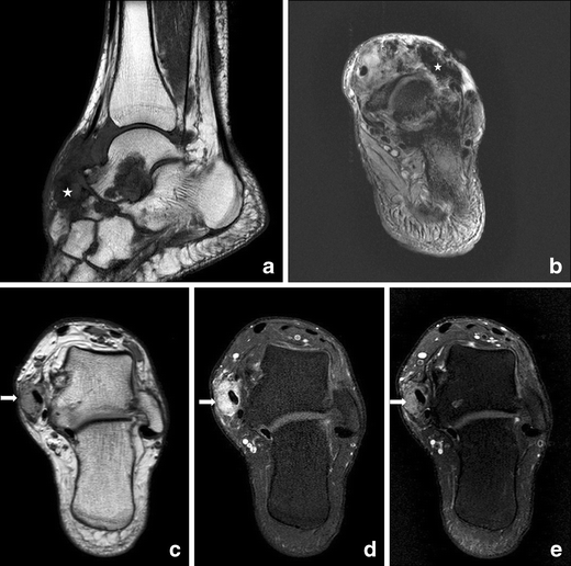 Lumps and bumps around the foot and ankle: an assessment of frequency ...