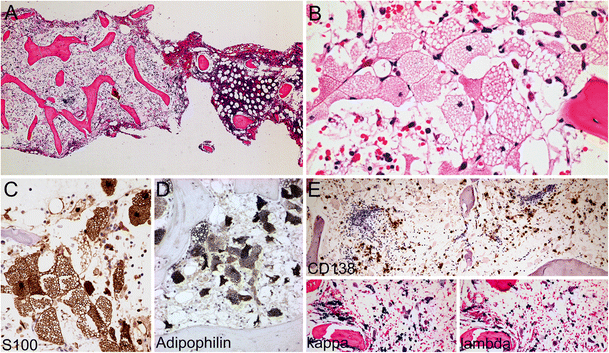 Intraosseous Hibernoma A Case Report And Review Of The Literature