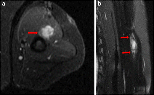 MRI characteristics of nodular fasciitis of the musculoskeletal system ...