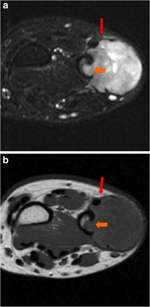 MRI characteristics of nodular fasciitis of the musculoskeletal system | SpringerLink