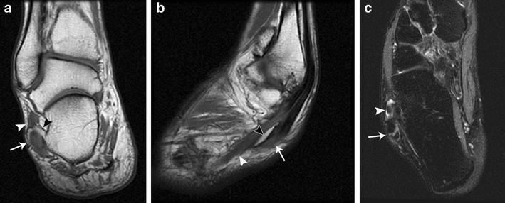Ultrasound and MRI of the peroneal tendons and associated pathology ...