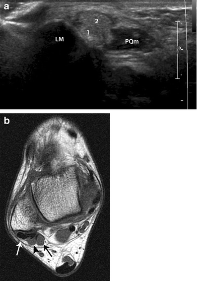 Ultrasound and MRI of the peroneal tendons and associated pathology ...