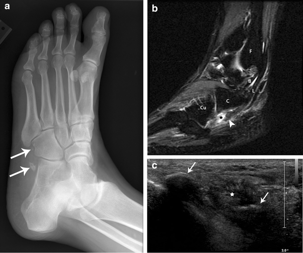 Ultrasound and MRI of the peroneal tendons and associated pathology ...