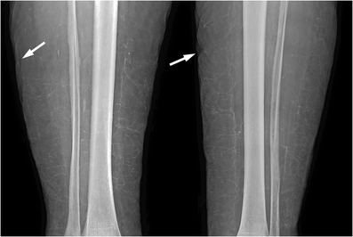 A case report: radiological findings in an unusual case of ...