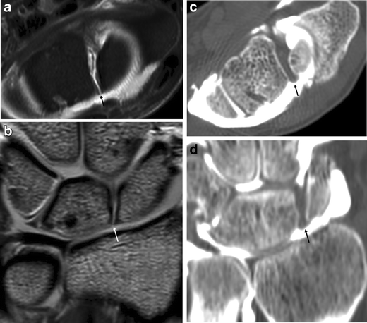 Intrinsic ligament and triangular fibrocartilage complex tears of the ...