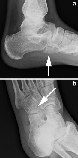 Os cuboideum secundarium: A rare accessory ossicle with the potential ...