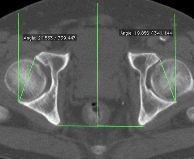 Comparison of acetabular version angle measurements between prone and ...
