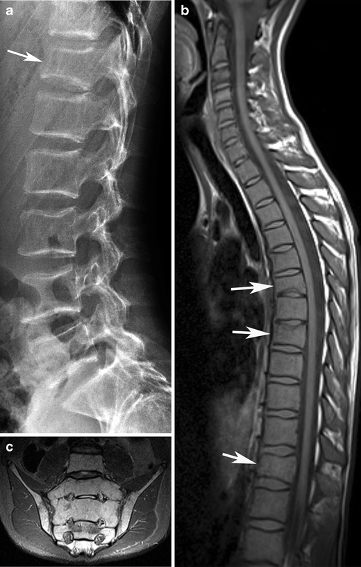 Paediatric acquired pathological vertebral collapse | SpringerLink