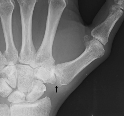 Imaging of radial wrist pain. Part II: pathology | SpringerLink