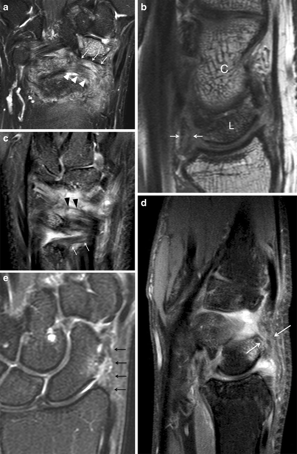 Imaging of radial wrist pain. Part II: pathology | SpringerLink