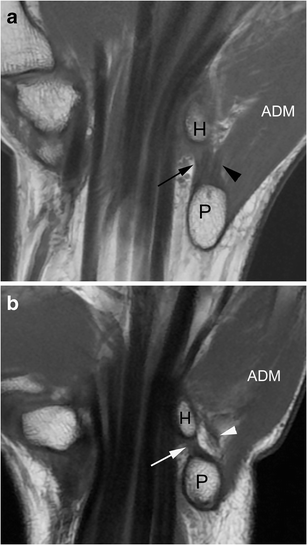 Pisotriquetral joint disorders: an under-recognized cause of ulnar side ...