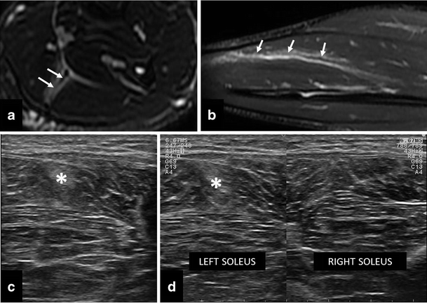 Soleus muscle injury: sensitivity of ultrasound patterns | SpringerLink