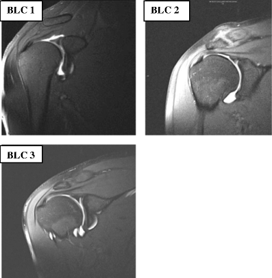 Magnetic resonance arthrography assessment of the superior labrum using ...