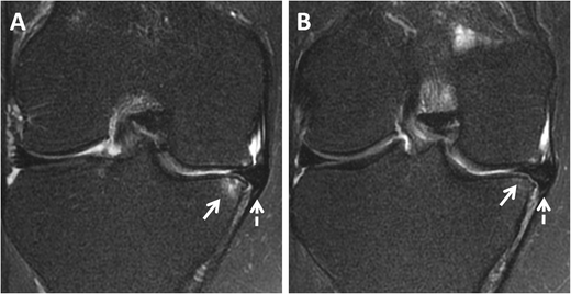The shiny corner of the knee: a sign of meniscal osteochondral unit ...