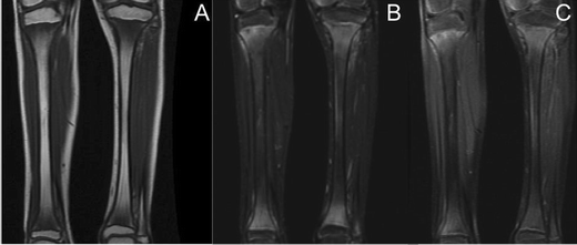 MRI findings in pediatric patients with scurvy | SpringerLink