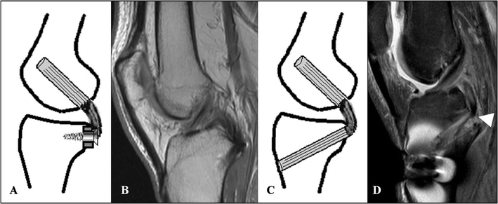 Imaging of posterior cruciate ligament (PCL) reconstruction: normal ...