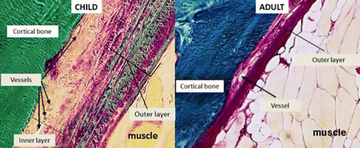 Periosteum: Characteristic imaging findings with emphasis on radiologic ...