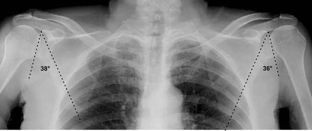 The scapular glenopolar angle: standard values and side differences ...