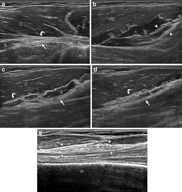 Pectoralis major tears: anatomy, classification, and diagnosis with ...